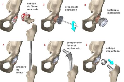 Prótese de Quadril artroplastia de quadril Instituto Trata