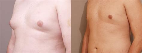 Male Breast Reduction In Webster TX Houston Plastic Reconstructive
