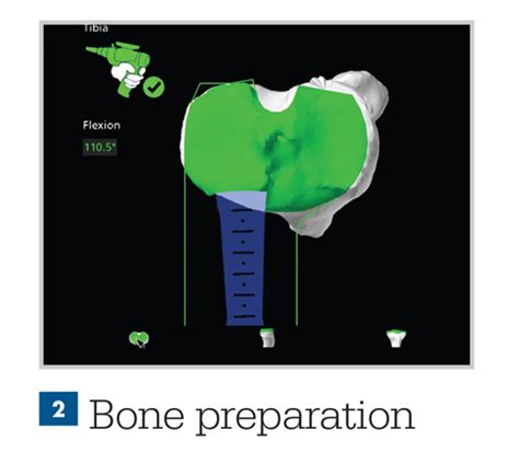 Mako Robotic Assisted Knee Replacement Florida Ortho Care