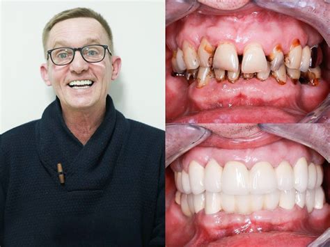 All On 6 Mexico High Quality Dental Implants By Dr Moguel