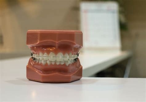 Cuánto Cuesta PONERSE BRACKETS en Estados Unidos