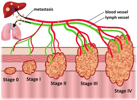 Stages Of Cancer Tumor Size