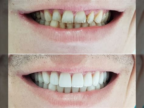 Lente de Contato Dental Paraíso São Paulo D amaro Odontologia
