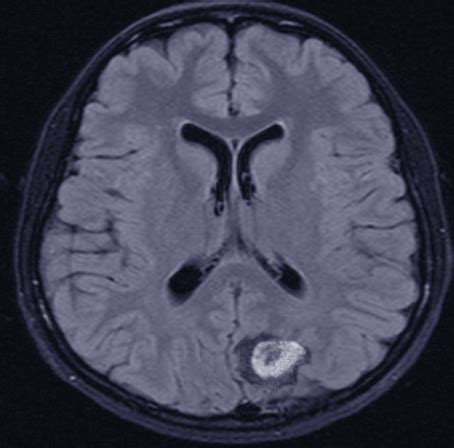 Central Nervous System Lymphoma Statpearls Ncbi Bookshelf