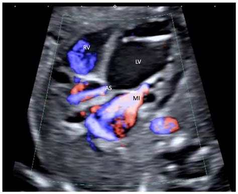 Left Outflow Tract In A Fetus With Severe Aortic Stenosis AS At 24