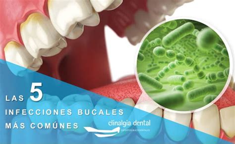 Infecciones Bucales M S Comunes