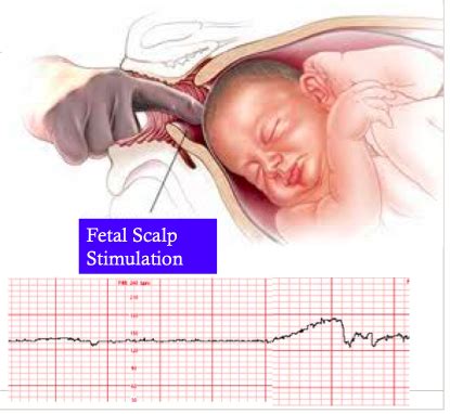 Fetal Monitoring Flashcards Quizlet