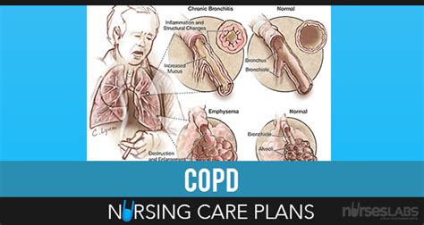 7 Chronic Obstructive Pulmonary Disease COPD Nursing Care Plans
