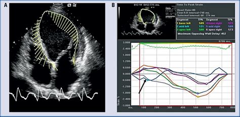 Regional Myocardial Contractile Reserve Assessed By Strain