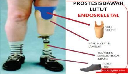 Introduction To Ue Amputation Prosthetics Flashcards Quizlet