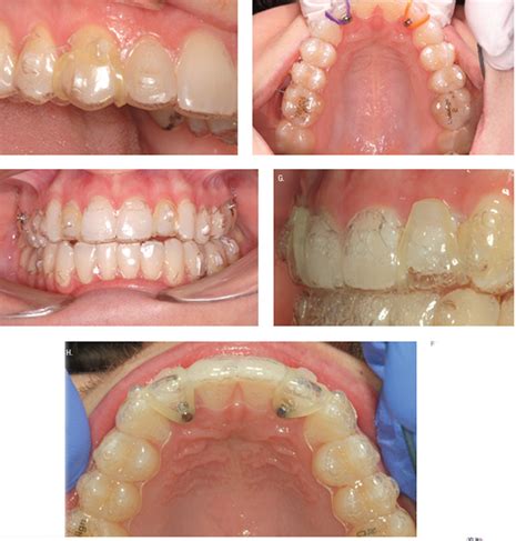 Clear Collection Instruments For Clear Aligner Treatments