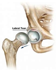 Hip Labral Repair Rehabilitation What To Expect Rehab Experts
