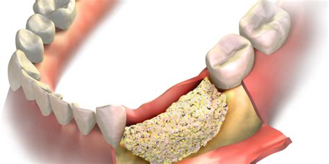 Regeneraci N Sea Dental Importante En Implantolog A