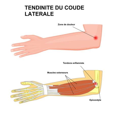Tendinite Du Coude Picondylite Comment La Soigner
