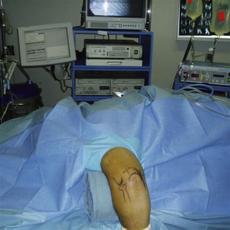 With The Patient In The Prone Position The Arthroscope Is Introduced