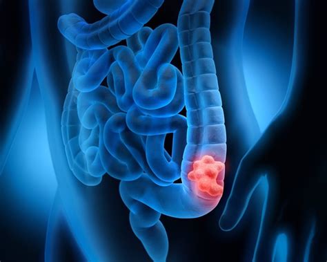 Estos son los principales factores de riesgo de cáncer de colon signos