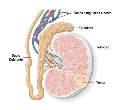 Câncer de Testículo e Retroperitônio Dr André Rezek Urologista em