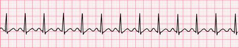 Cardiac Arrhythmias Sinus Bradycardia Sinus Tachycardia Multifocal