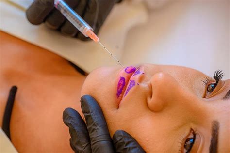 Preenchimento Labial Guia Completo tudo que você precisa saber