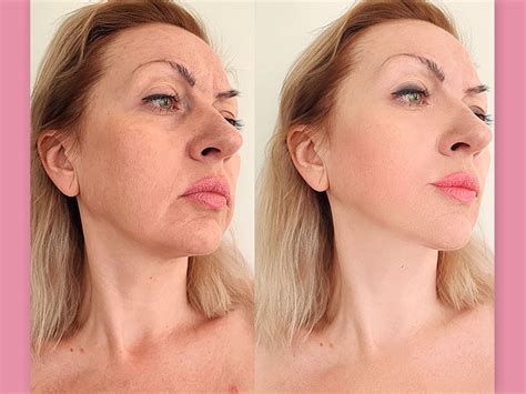 Sculptra O que é preço e resultados Dream Plastic