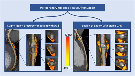 Pericoronary Adipose Tissue Attenuation In Patients With Acute Coronary