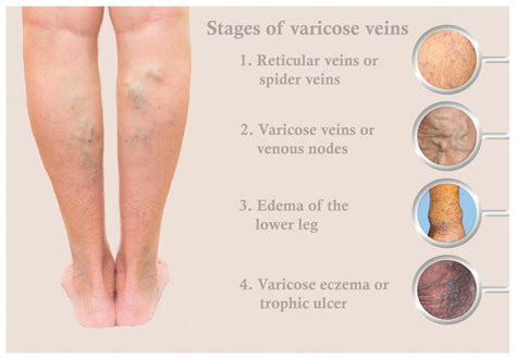What Are Reticular Veins The Vein Institute