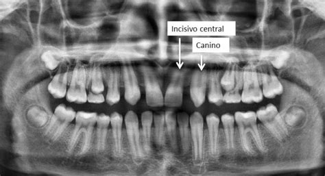 Agenesia dental qué es y cómo se trata Ortodoncia Ourense