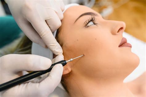 Skin Moles Removal