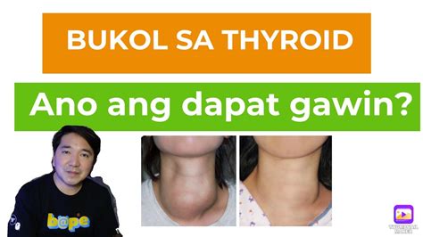 Bukol Sa Leeg Puede Hindi Operahan Youtube
