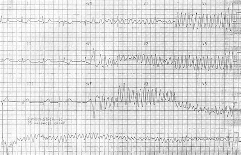 Ventricular Fibrillation VF LITFL ECG Library Diagnosis