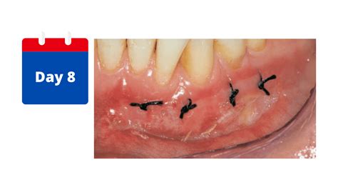 The Different Healing Stages Of A Gum Graft Day By Day Pictures