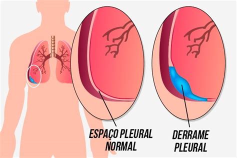 Derrame Pleural O Que Porque Acontece Sintomas E Tratamento Tua