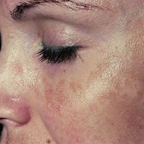 manchas piel cara 01 Centro de Estética Elena Somoano Oviedo