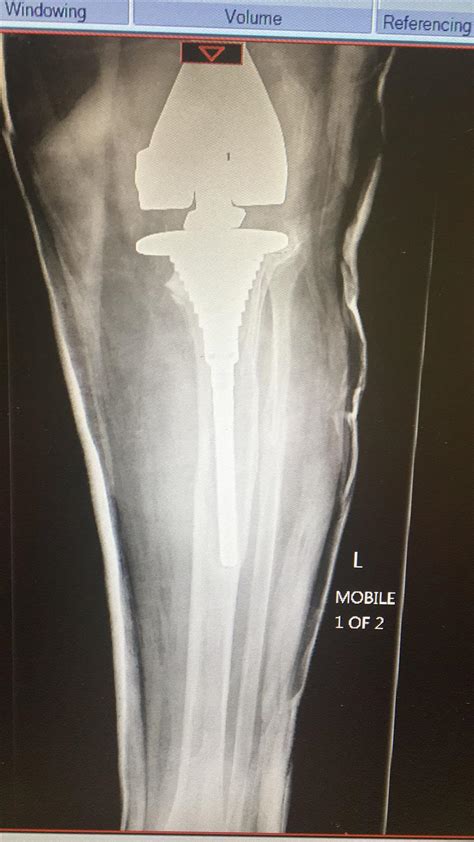Tka Periprosthetic Fracture Recon Orthobullets