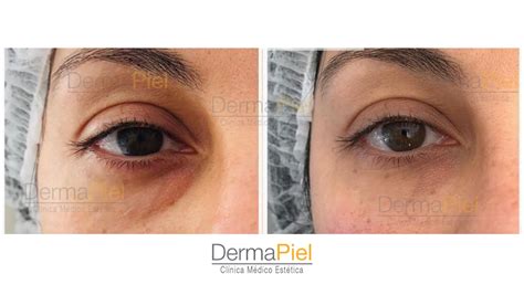Relleno De Ojeras Dermapiel