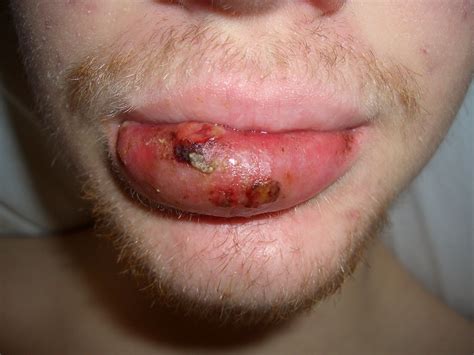 Staph Infection On Lips