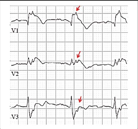 Fragmented QRS In The Right Precordial Leads Of A Brugada Syndrome