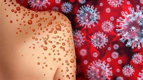Variole Du Singe Comment Le Monkeypox Se Transmet Il