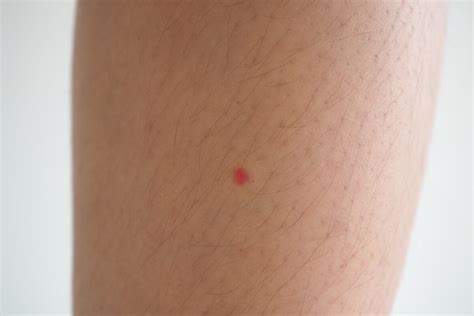 FALSO de primera categoría personaje manchas rojas en las piernas