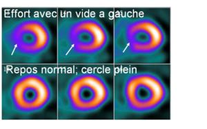 Scintigraphie myocardique ou MIBI à leffort Icardio