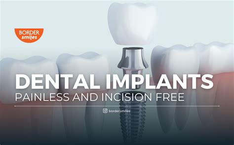 DENTAL IMPLANTS PAINLESS AND INCISION FREE Border Smiles