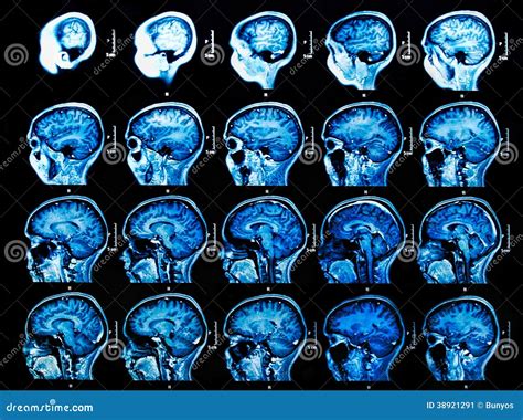 Healthy Brain MRI Scan