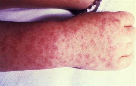 Qué es la Rickettsia y cómo se contagia