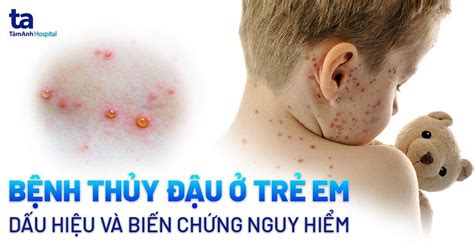 Tiem Phong Thuy Dau Cho Tre Khi Nao Discount Emergencydentistry
