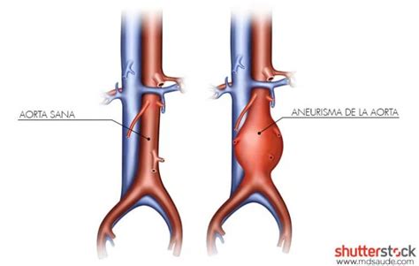 ANEURISMA DE LA AORTA ABDOMINAL MD Saúde