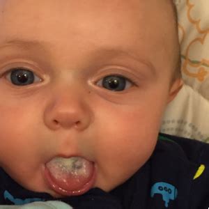 Baby Has Black In His Tongue August Babies Forums What To