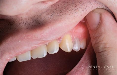 Fístula dental síntomas causas y tratamiento Dental Care Barcelona