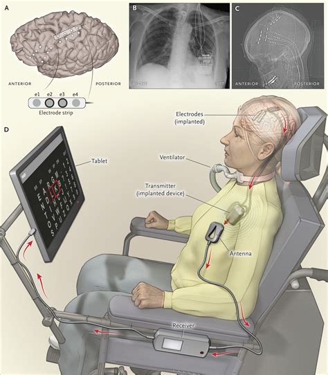 Fully Implanted BrainComputer Interface In A Locked In Patient With