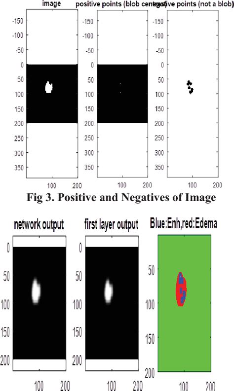 segmentation and detection of tumor in mri images using cnn and svm classification semantic