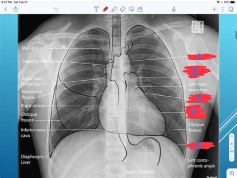 Chest X Ray Flashcards Quizlet